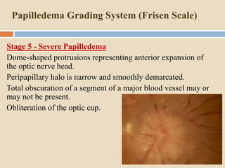 Papilledema Grading