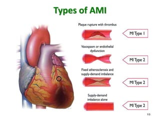 5. MYOCARDIAL INFARCTION.ppt