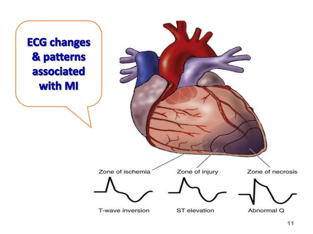 5. MYOCARDIAL INFARCTION.ppt