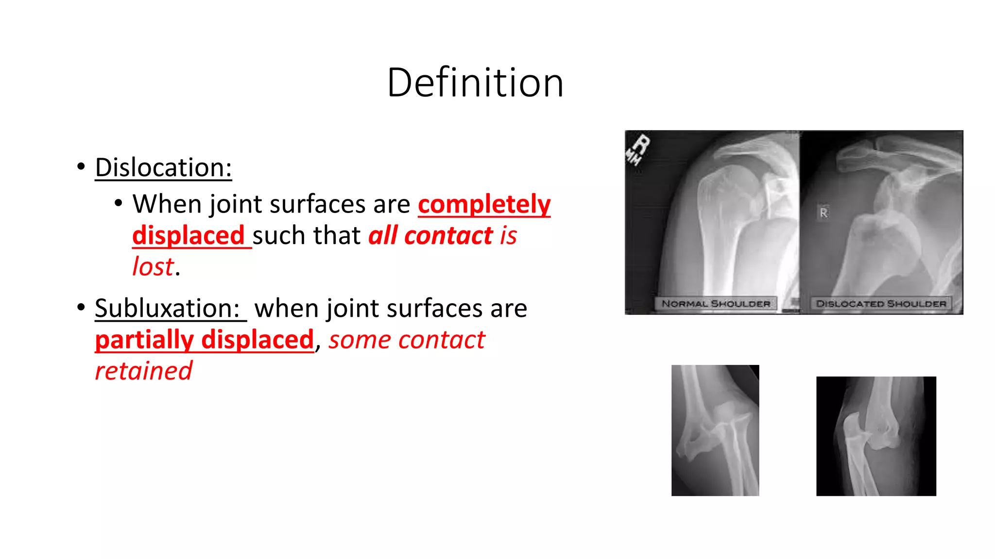 Common Dislocations and subluxations | PPTX