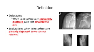 Common Dislocations and subluxations | PPTX