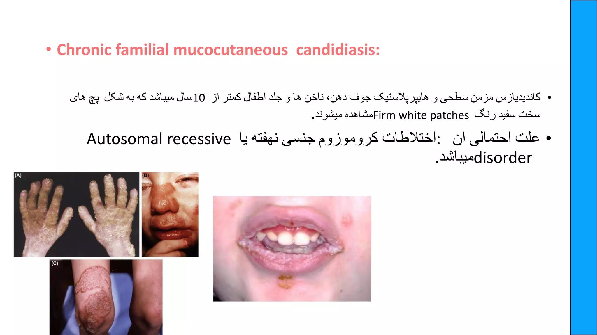 5. Chronic mucocutaneous candidiasis.pptx