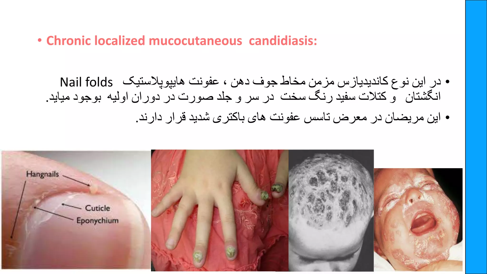 5. Chronic mucocutaneous candidiasis.pptx
