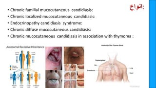 5. Chronic mucocutaneous candidiasis.pptx