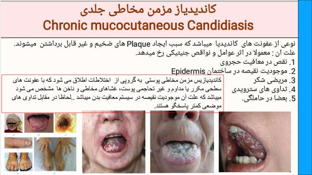 5. Chronic mucocutaneous candidiasis.pptx