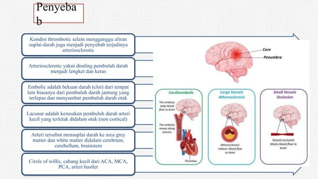 5. Cerebrovascular Accident.pptx