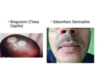 5. SCALP INFECT-WPS Office.pdf