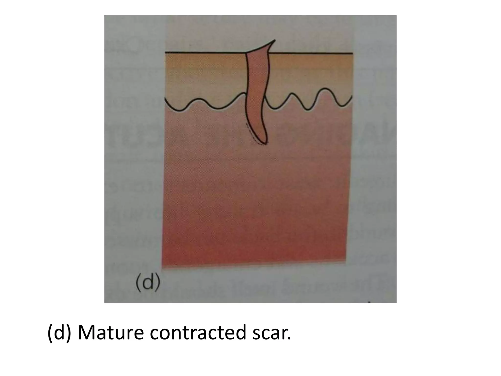 5.1 Wounds, normal wound healing and factors affecting healing (2).pptx