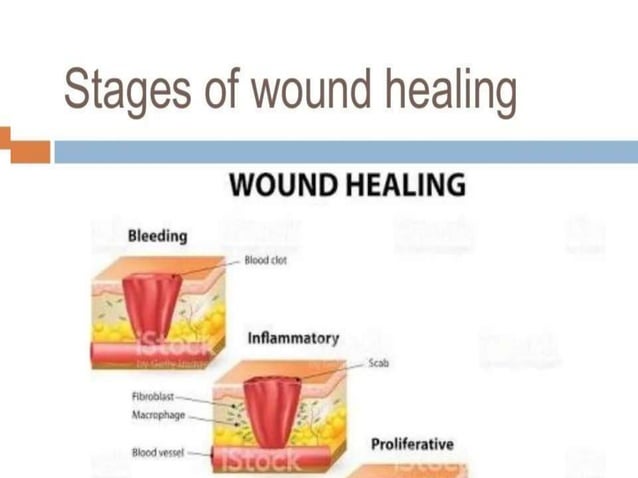 5.1 Wounds, normal wound healing and factors affecting healing (2).pptx