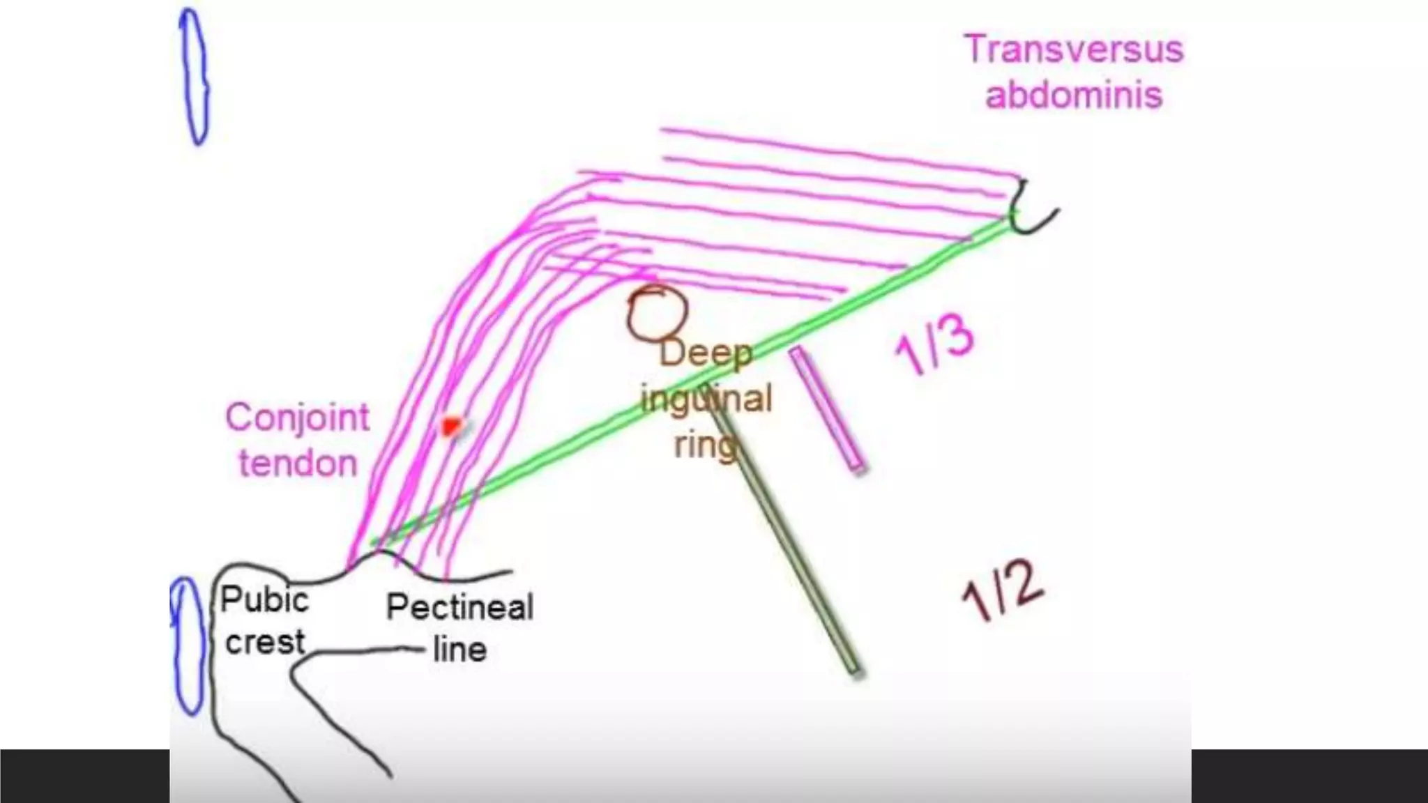 5. Inguinal Hernia & Surgical Anatomy.pptx