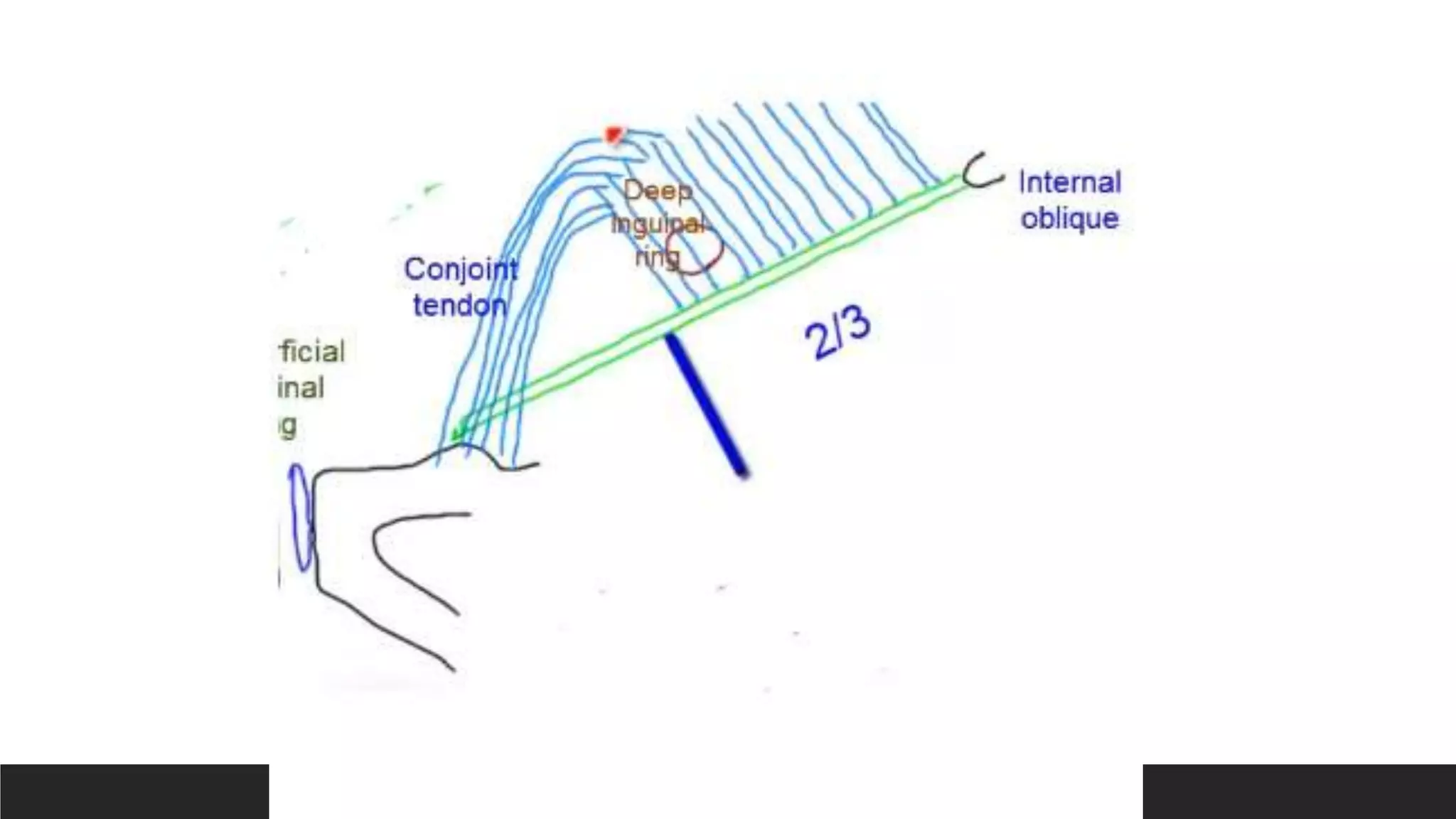 5. Inguinal Hernia & Surgical Anatomy.pptx