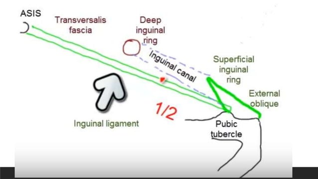 5. Inguinal Hernia & Surgical Anatomy.pptx