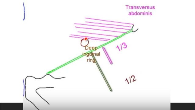 5. Inguinal Hernia & Surgical Anatomy.pptx