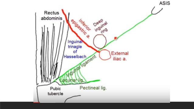5. Inguinal Hernia & Surgical Anatomy.pptx
