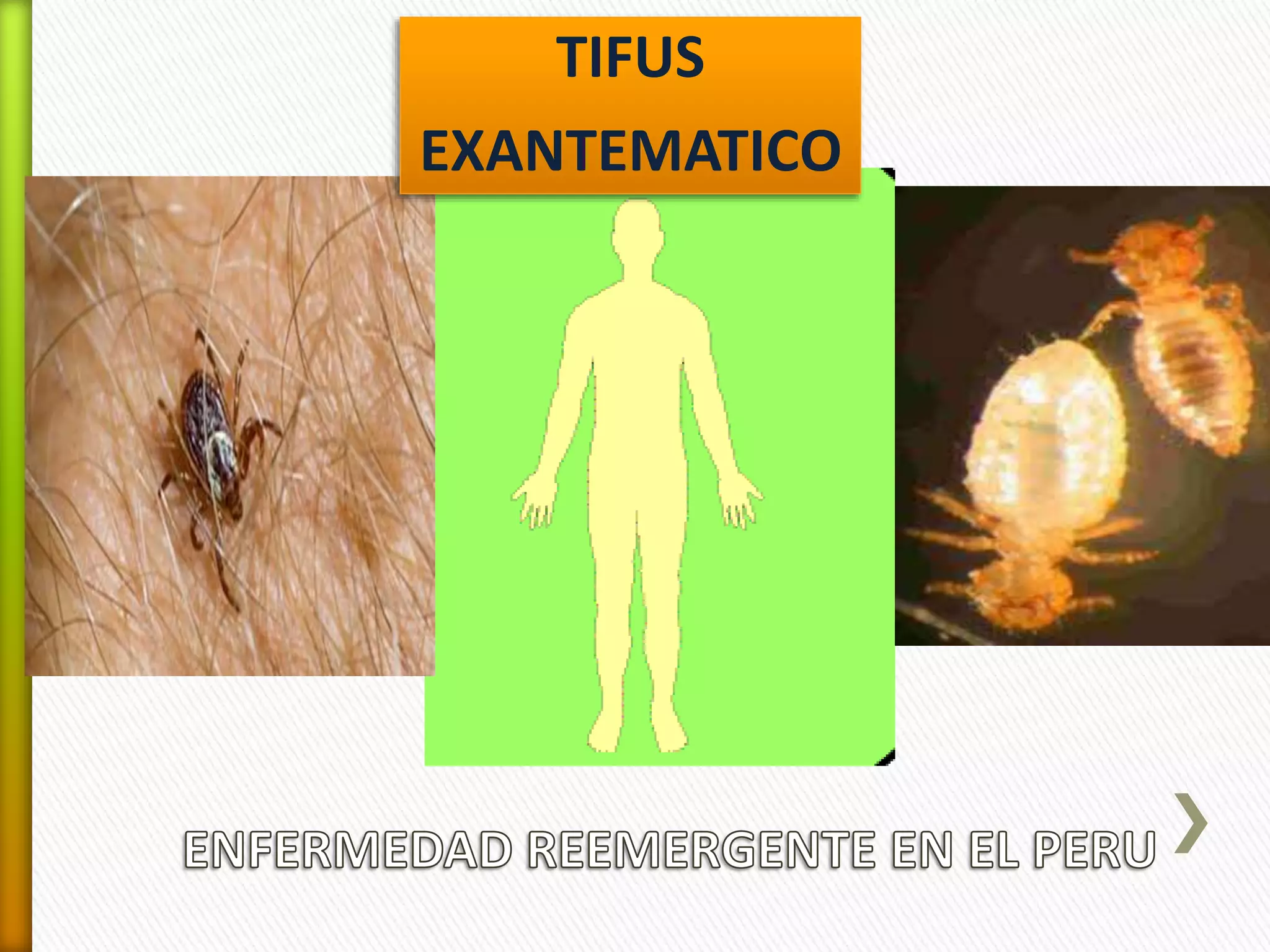 5.TIFUS.pptx