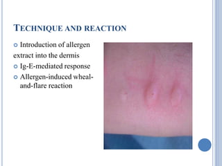 Allergic reactions.pptx