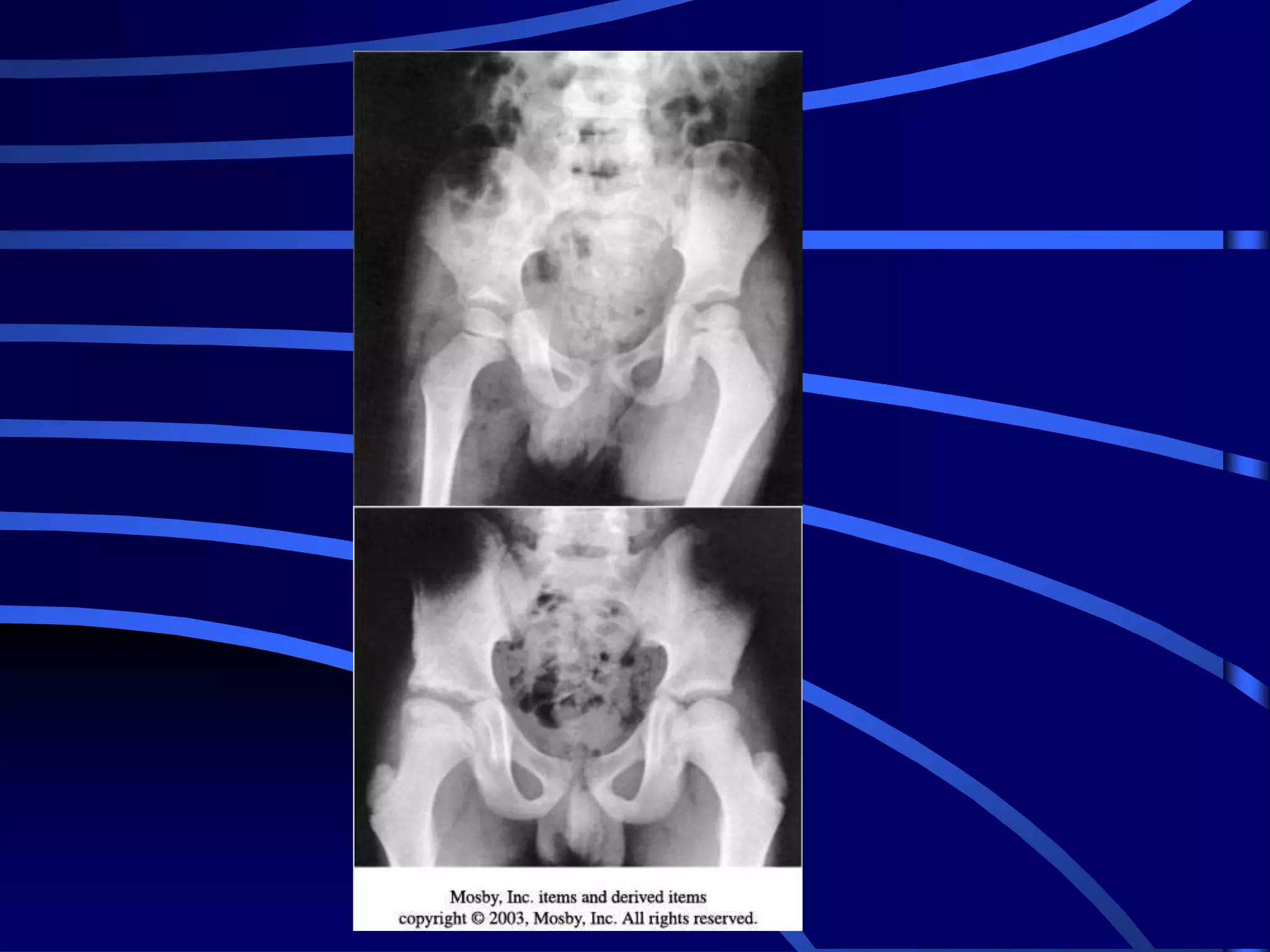 Tuberculosis of Bone and Joint.ppt