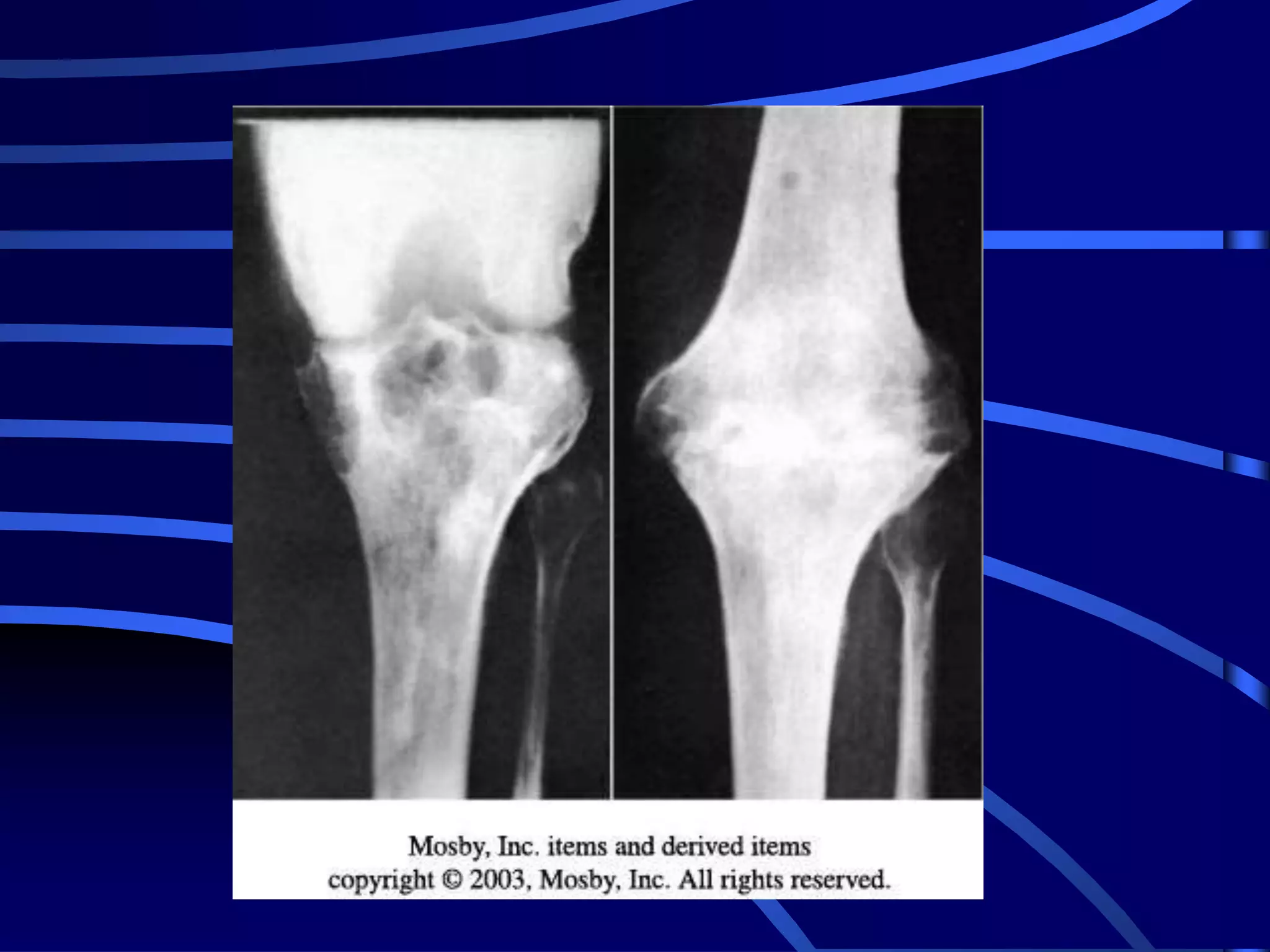 Tuberculosis of Bone and Joint.ppt | Bone and Joint Conditions ...