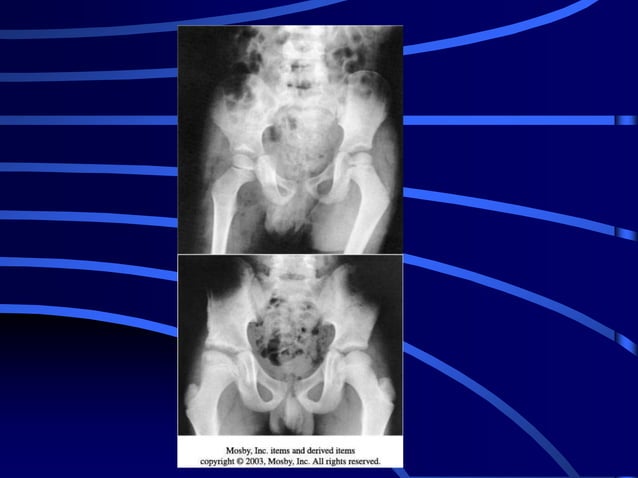 Tuberculosis of Bone and Joint.ppt | Bone and Joint Conditions ...