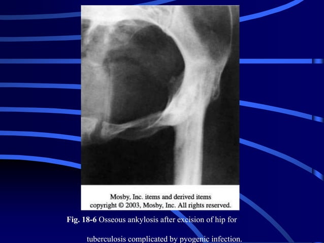 Tuberculosis of Bone and Joint.ppt | Bone and Joint Conditions ...