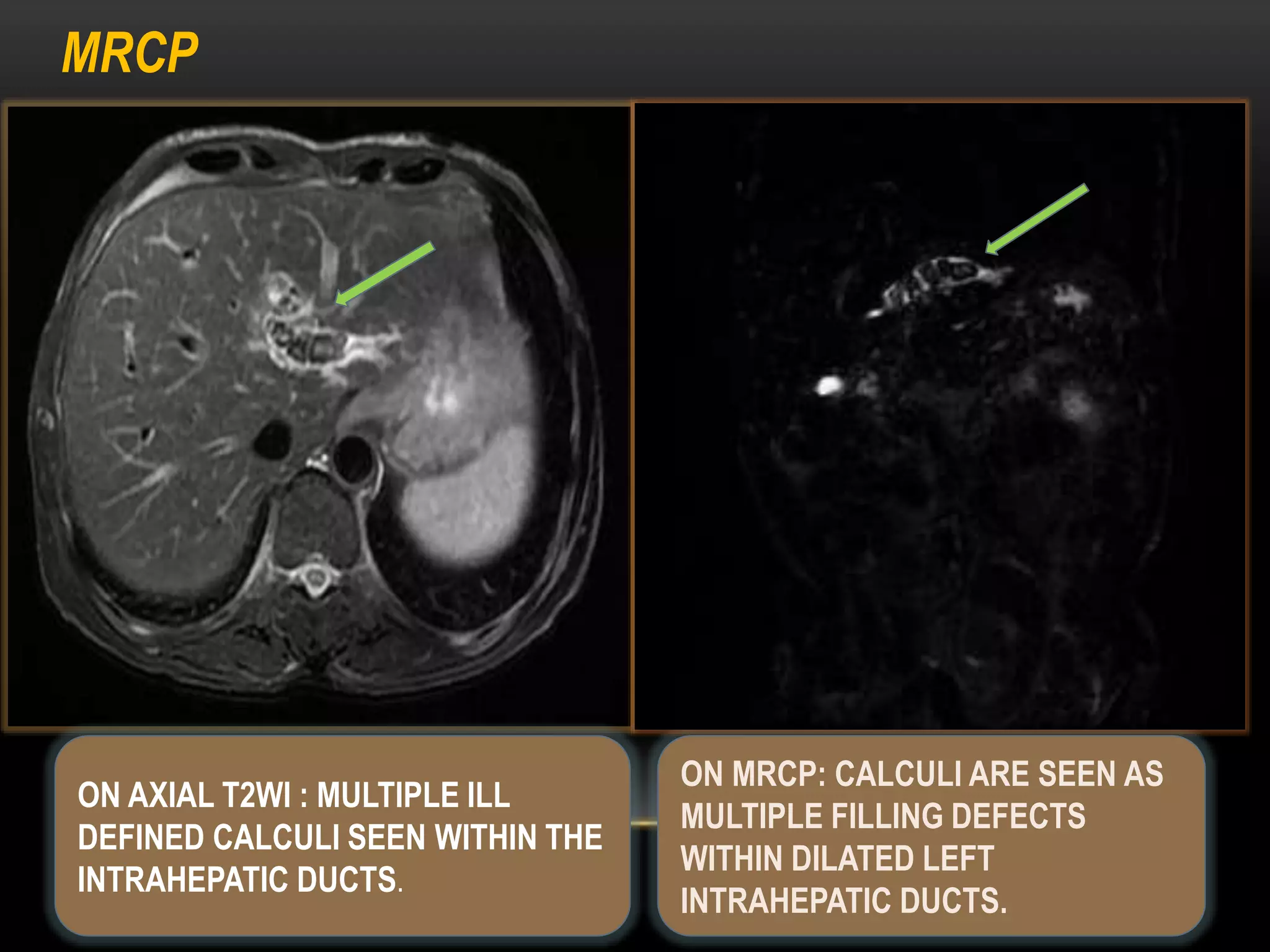 5. Intra hepatic calculi.pptx
