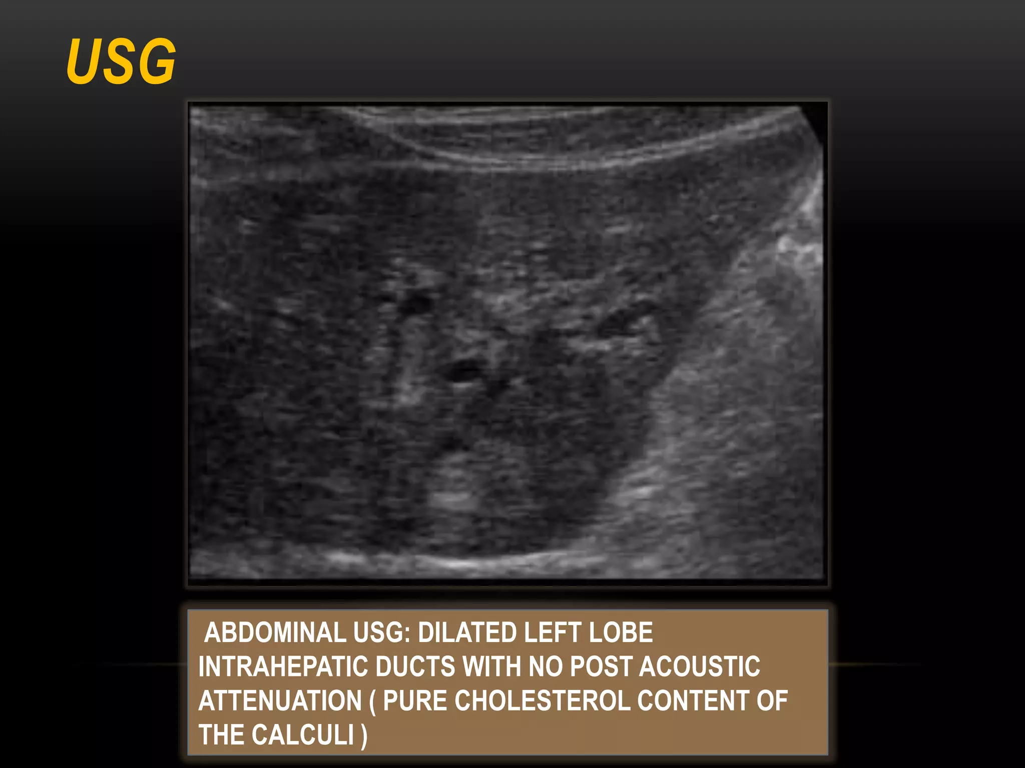 5. Intra hepatic calculi.pptx