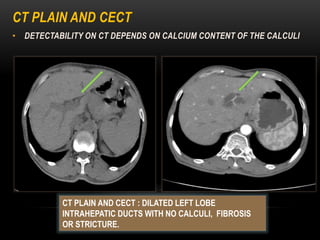 5. Intra hepatic calculi.pptx
