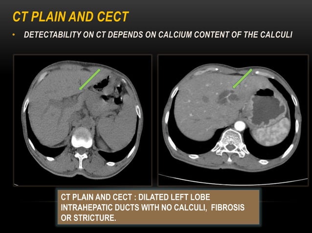 5. Intra hepatic calculi.pptx