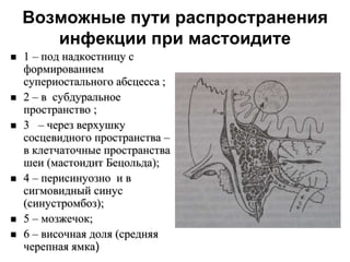5.-Zabolevaniya-naruzhnogo-ukha_-ostryy-otit_-mastoidit.ppt