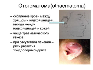 5.-Zabolevaniya-naruzhnogo-ukha_-ostryy-otit_-mastoidit.ppt