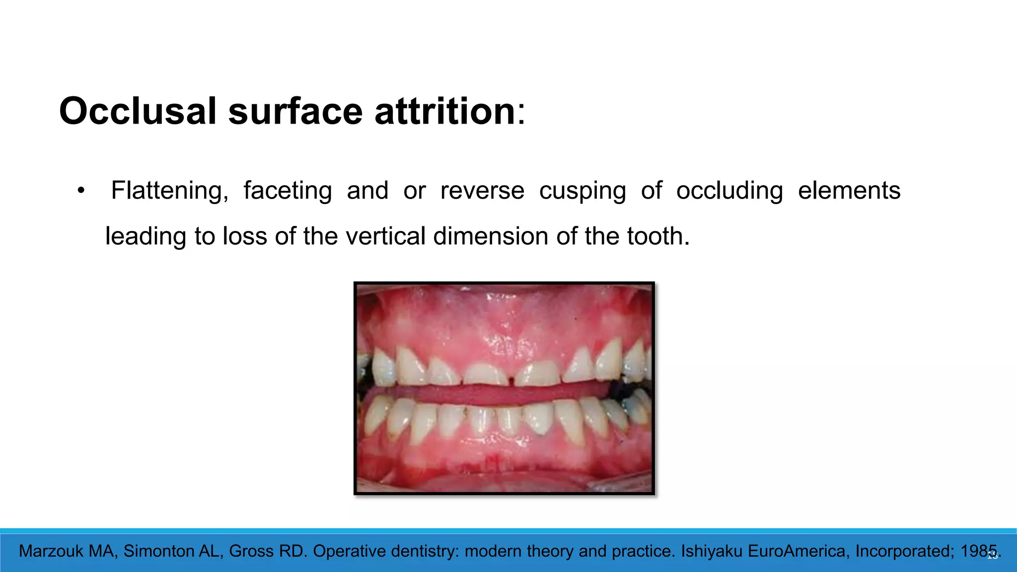 NON CARIOUS DESTRUCTION AND DISFIGUREMENT OF TEETH (20.9.21).pptx