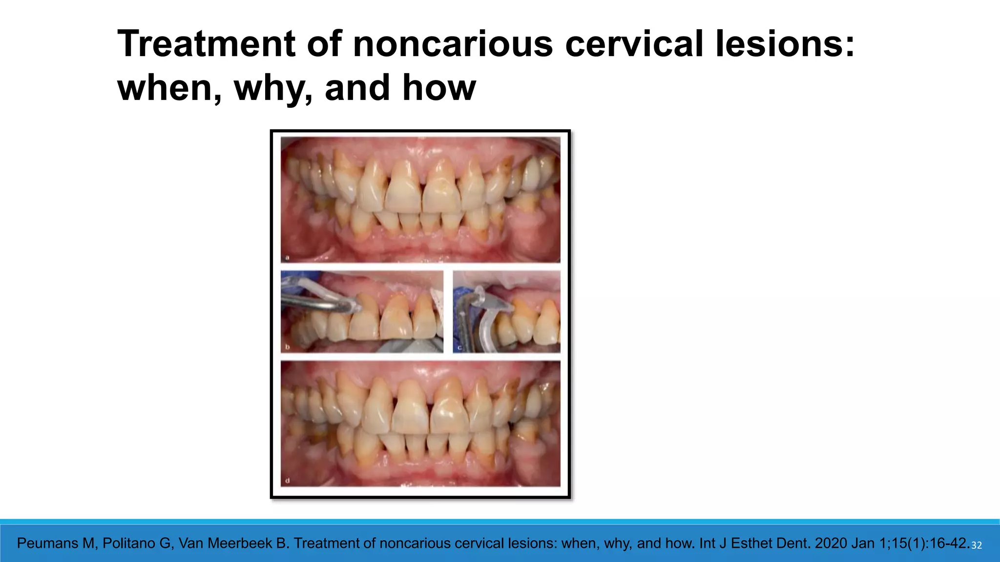 NON CARIOUS DESTRUCTION AND DISFIGUREMENT OF TEETH (20.9.21).pptx