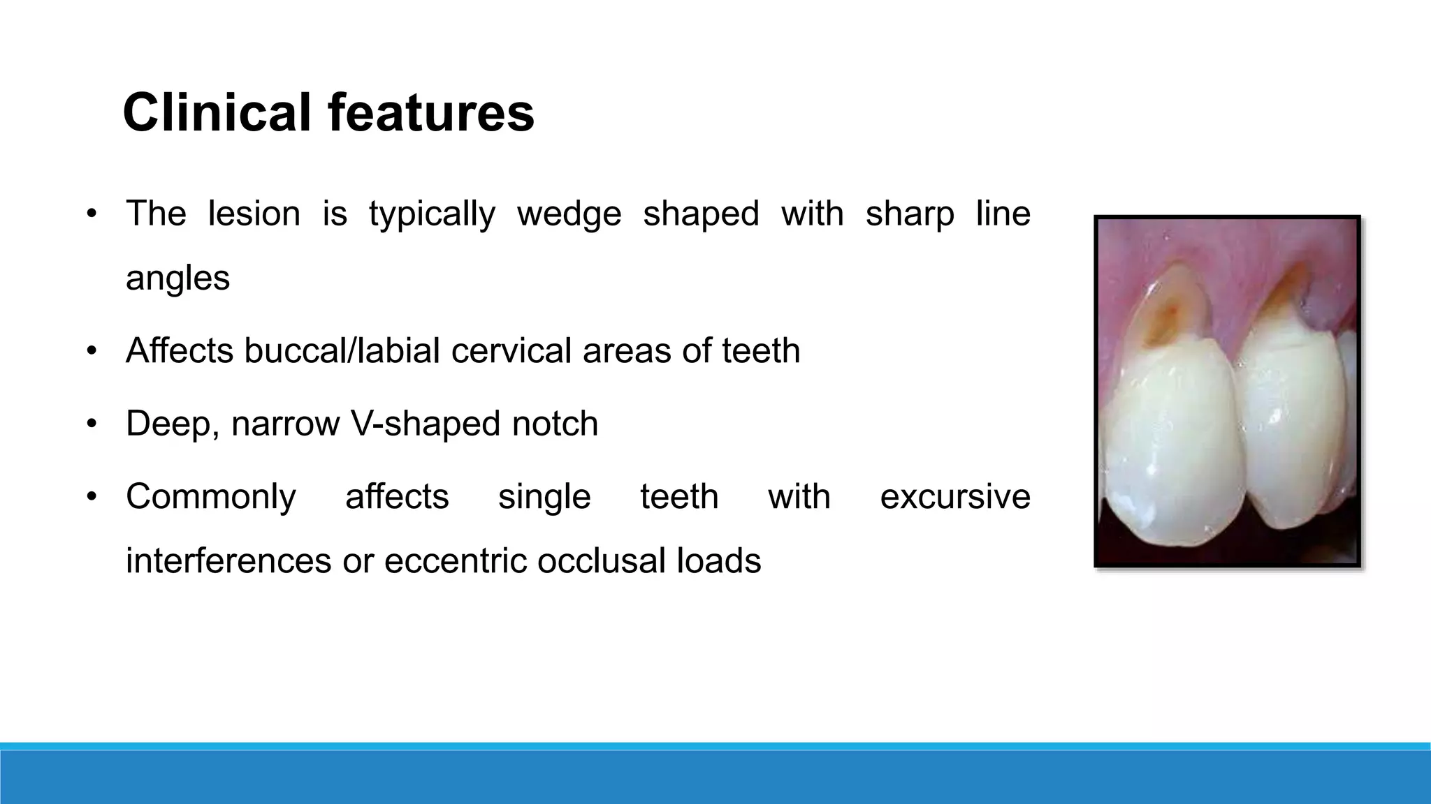 NON CARIOUS DESTRUCTION AND DISFIGUREMENT OF TEETH (20.9.21).pptx