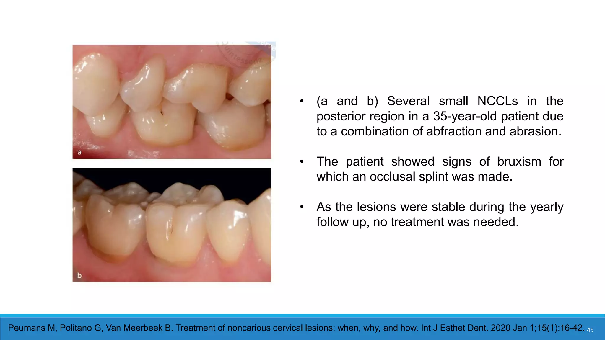 NON CARIOUS DESTRUCTION AND DISFIGUREMENT OF TEETH (20.9.21).pptx