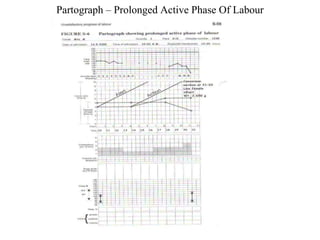 5.1 Partograph.ppt