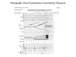 5.1 Partograph.ppt