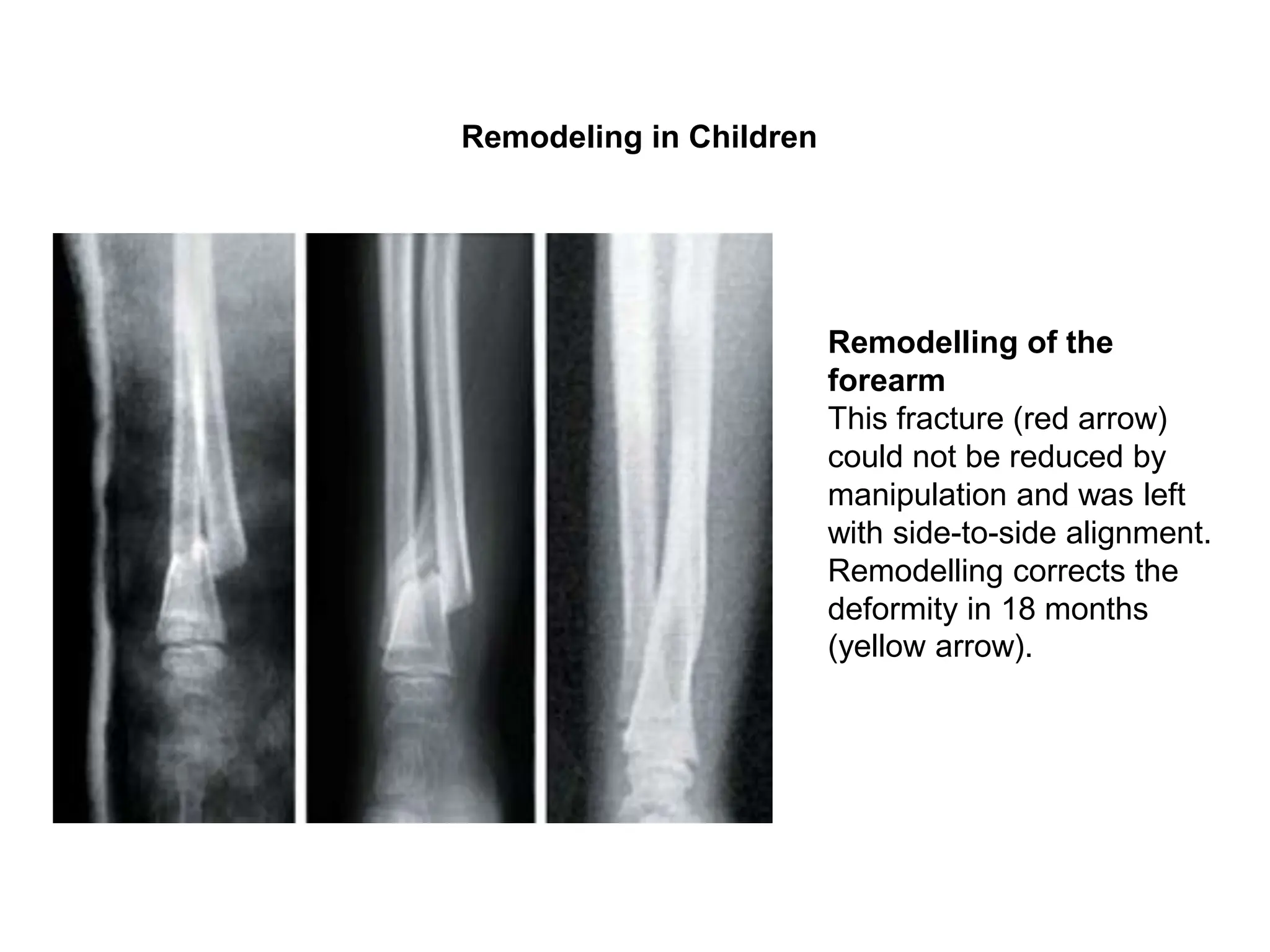 Principles, pitfalls & problems of Paediatrics Fractures AKU 2023.pptx ...