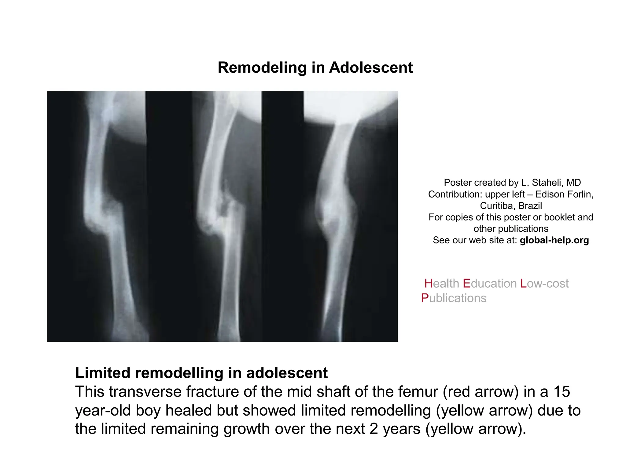 Principles, pitfalls & problems of Paediatrics Fractures AKU 2023.pptx ...