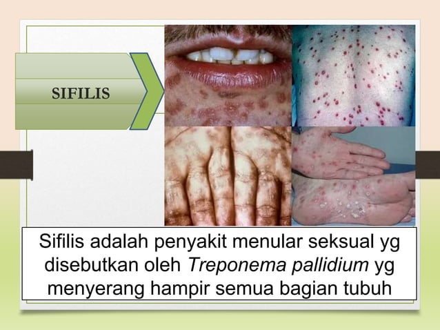 Sifilis Penyakit Menular Seksual ....pptx