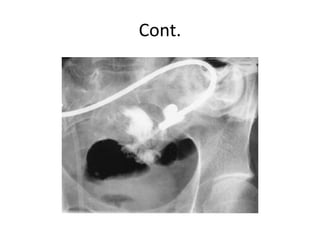 5.Intestinal Fistulas.pptx