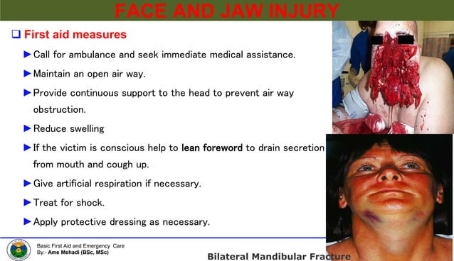 First Aid for management of Specific Injuries.pptx