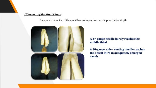 VARIOUS ROOT CANAL IRRIGANTS IN ENDODONTICS | PPTX