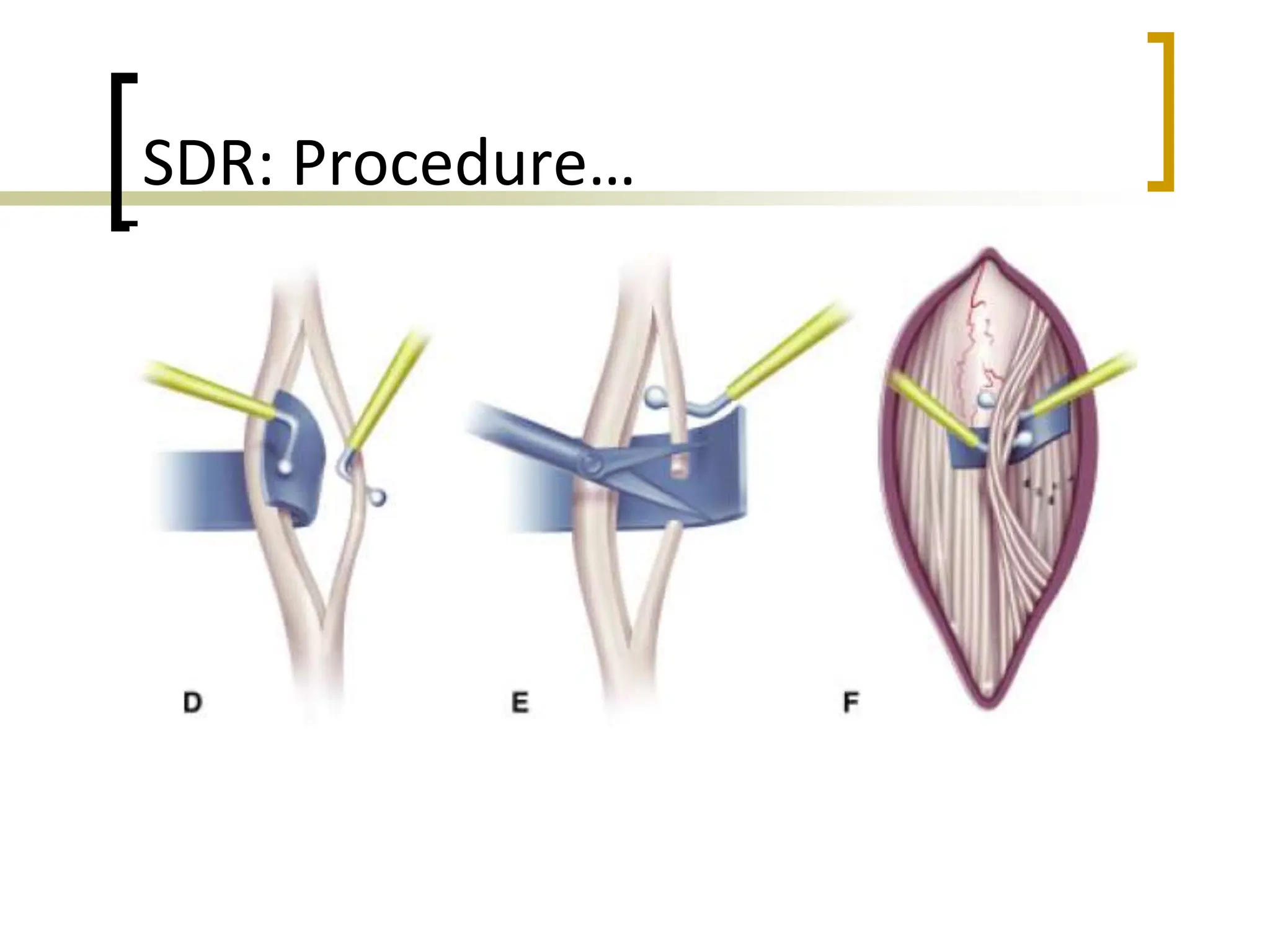 5. Spasticity causes and neurosurgical management .pptx