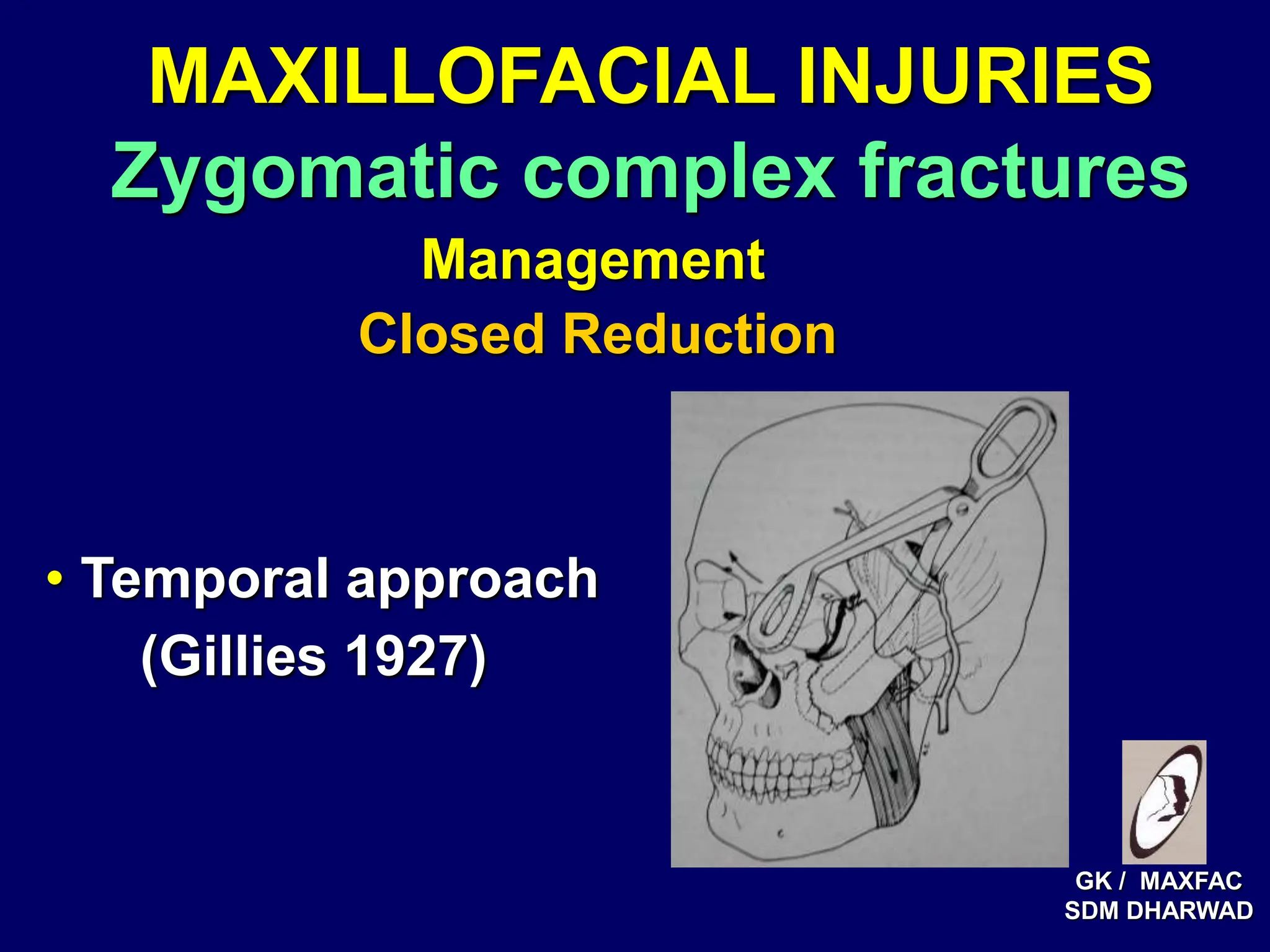 zygoma fracture inju & complications.ppt