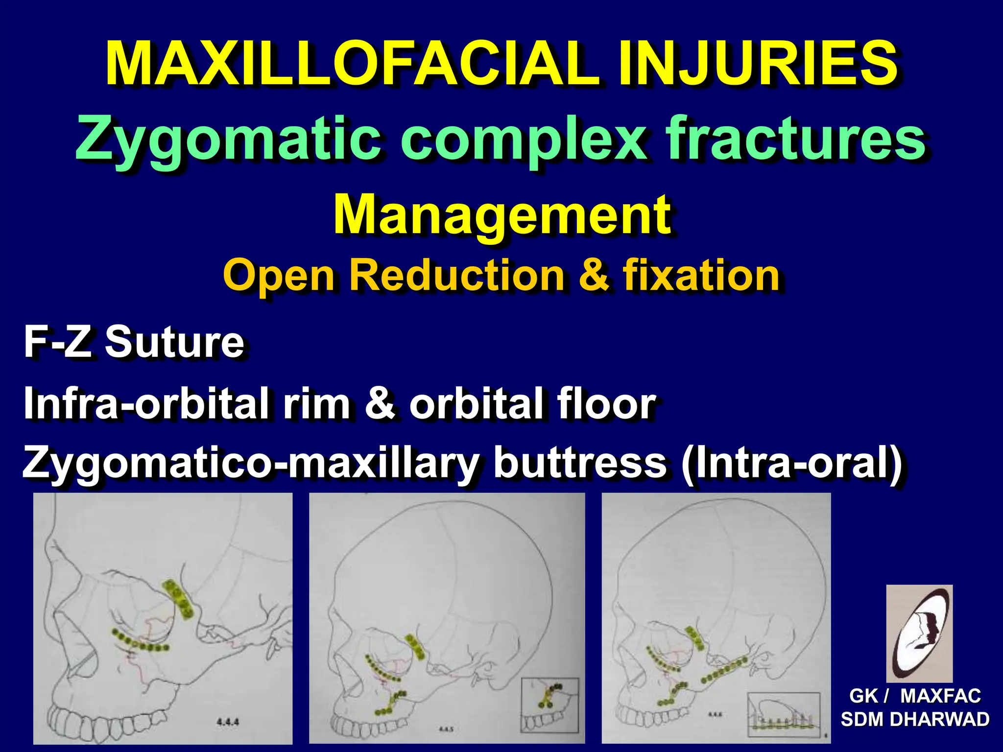 zygoma fracture inju & complications.ppt