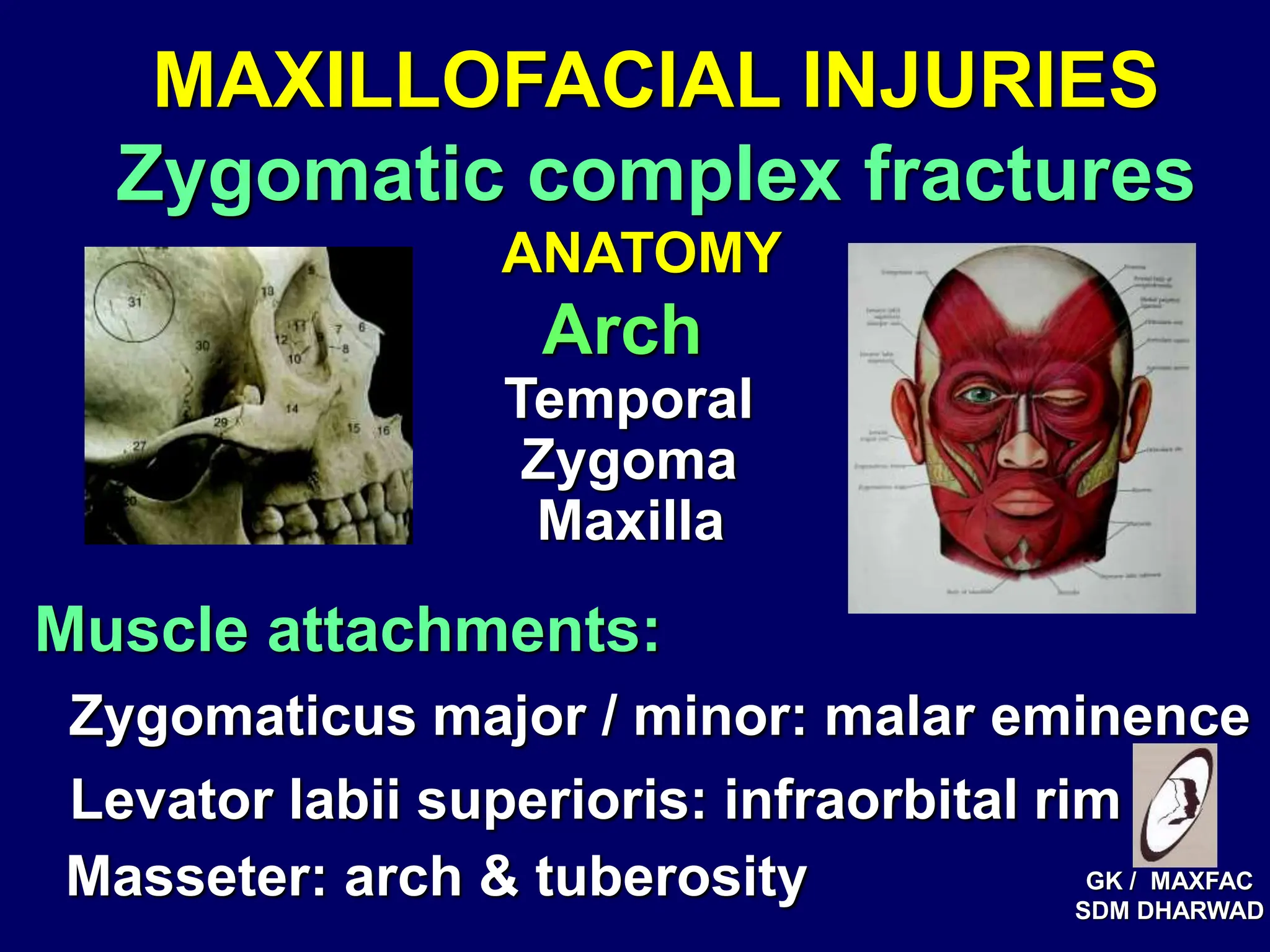 zygoma fracture inju & complications.ppt