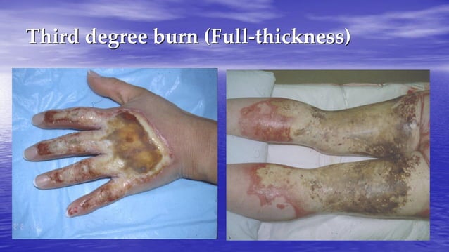 5. Burns and Skin Grafts.pdf this slides contains | PDF