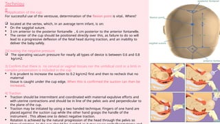 5.Operative and instrumental Vaginal Delivery. OBGYN | PPTX