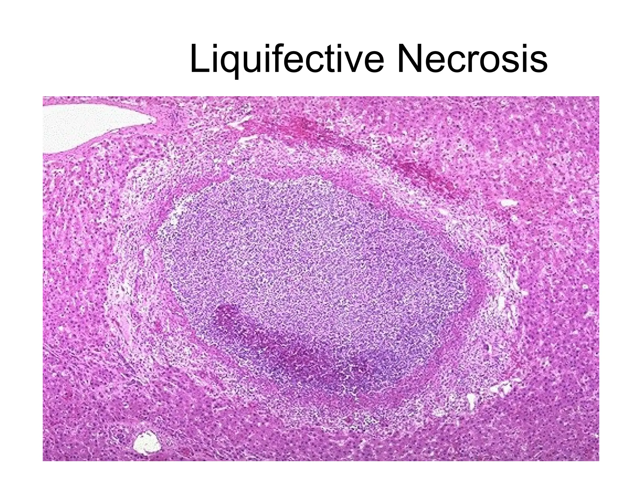 5. Necrosis.ppt 6877987969879877987987878 | PPT