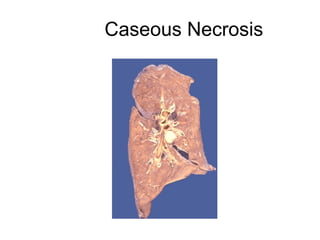 5. Necrosis.ppt 6877987969879877987987878 | PPT
